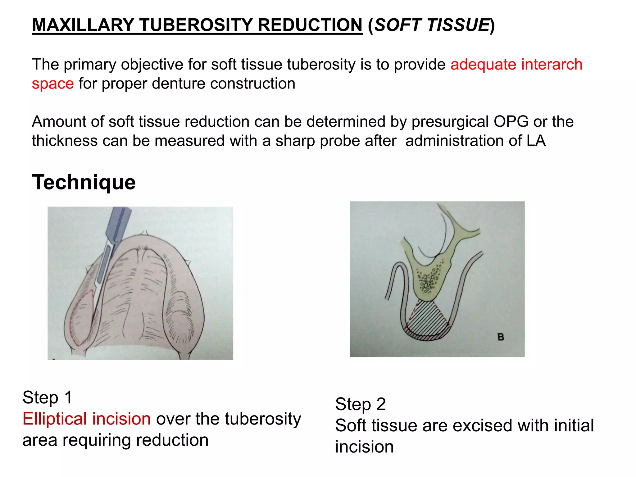 Preprosthetic surgery.pdf