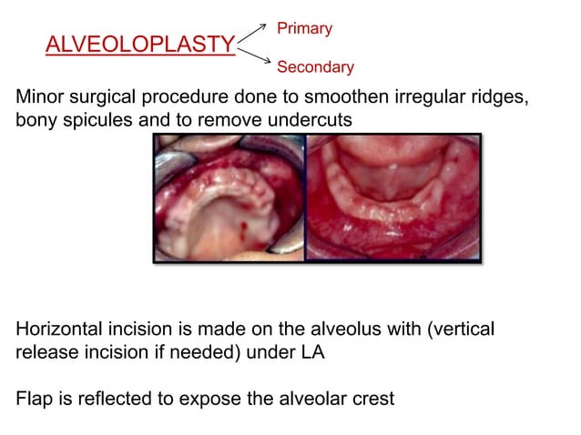 Preprosthetic surgery.pdf