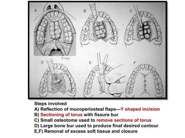 Preprosthetic surgery.pdf