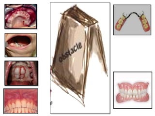 Preprosthetic surgery.pdf