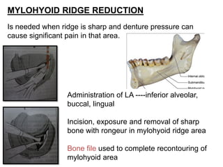 Mylohyoid Ridge Reduction