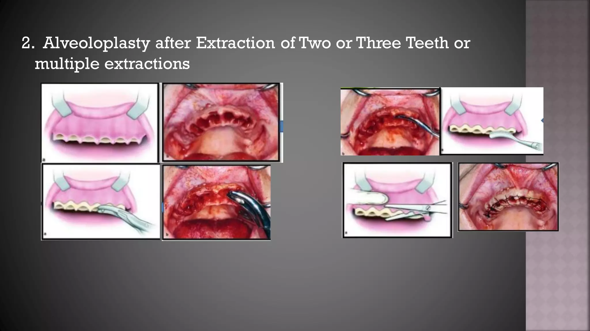 PREPROSTHETIC SURGERY.pdf