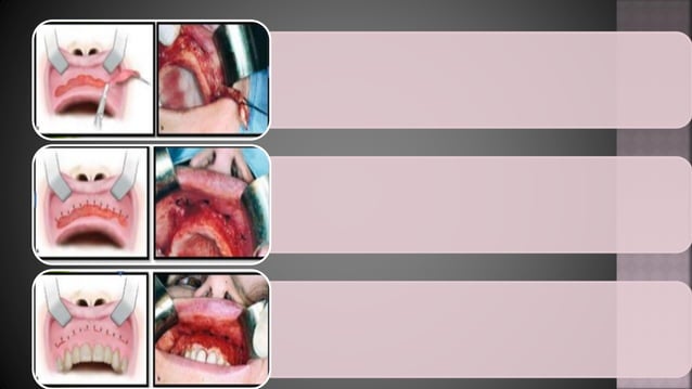 PREPROSTHETIC SURGERY.pdf