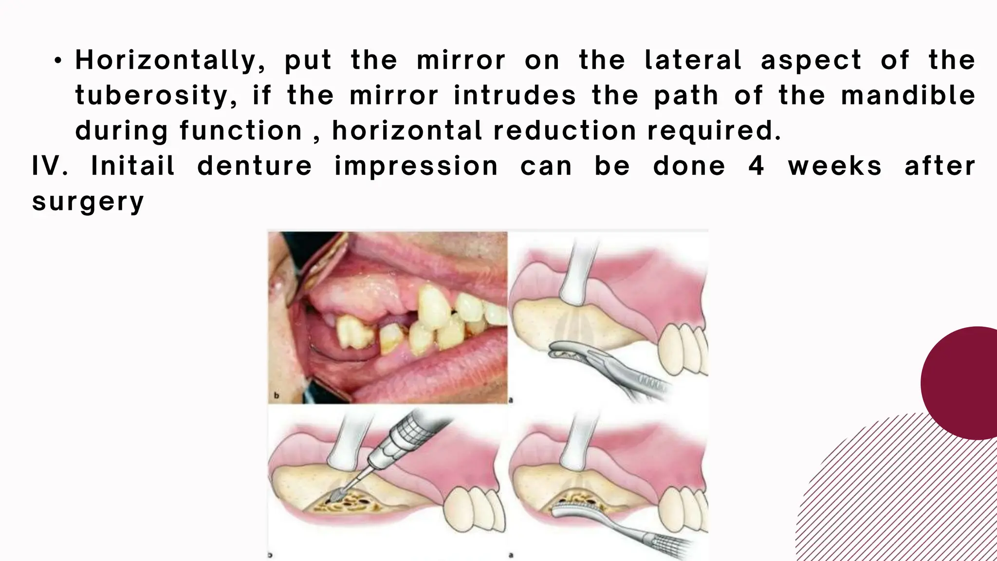 Pre prosthetic surgery ........... pptx | PPTX | Surgery | Medical Health