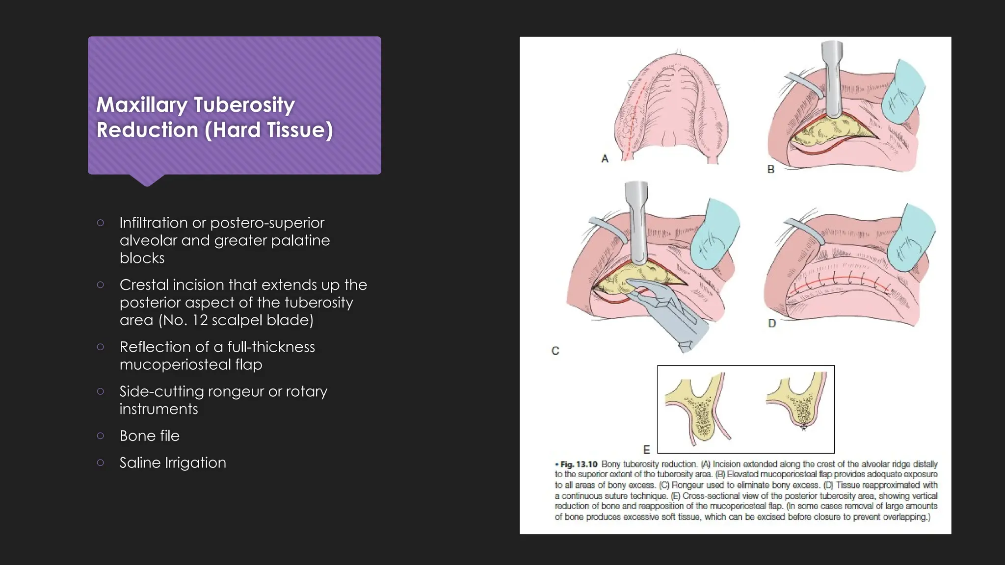 Preprosthetic oromaxillofacial Surgery.pptx