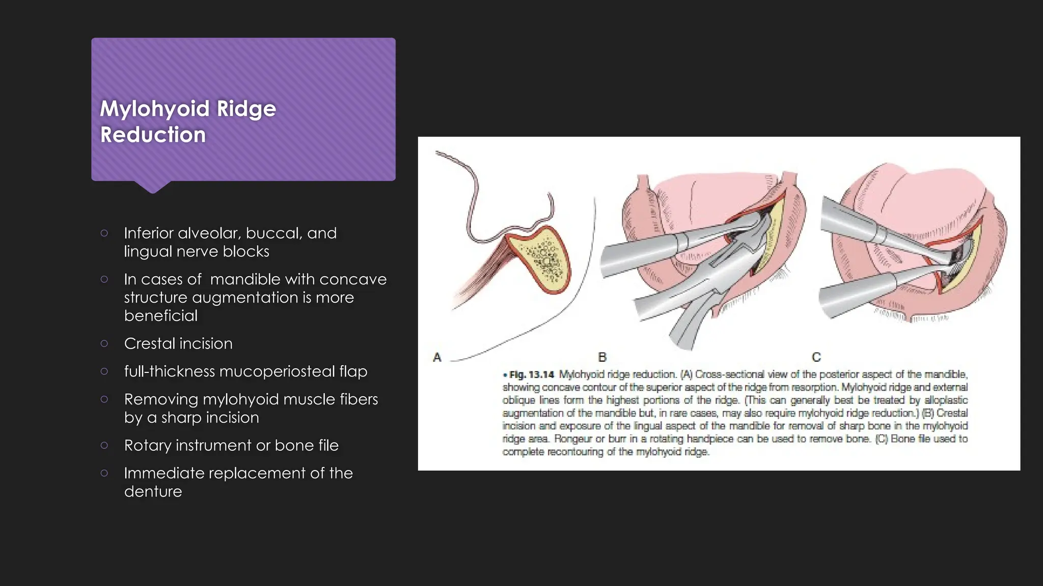 Preprosthetic oromaxillofacial Surgery.pptx