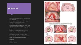 Preprosthetic oromaxillofacial Surgery.pptx