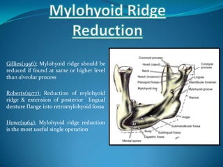 Mylohyoid Ridge Reduction