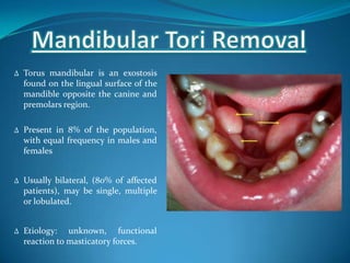 Torus Mandibularis Removal