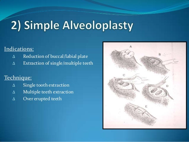Pre prosthetic surgery (2)