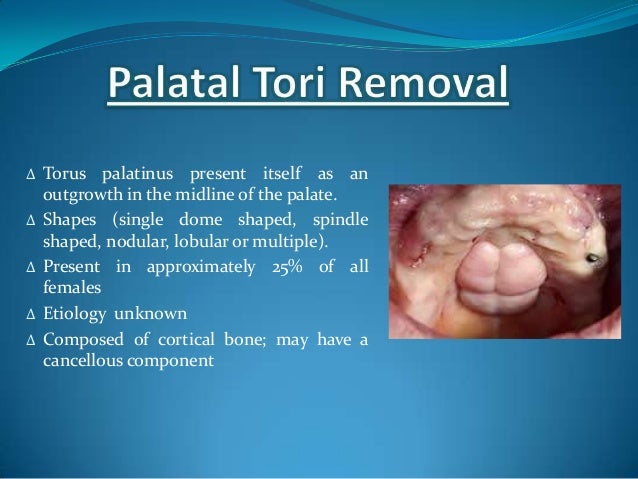Mandibular Tori Causes