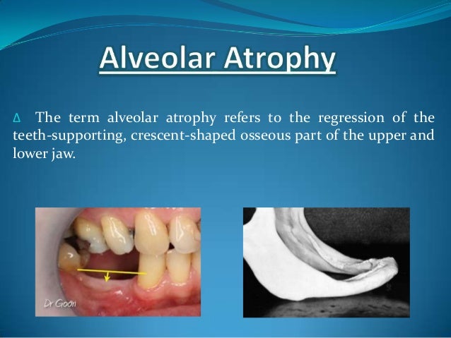 Pre prosthetic surgery (2)