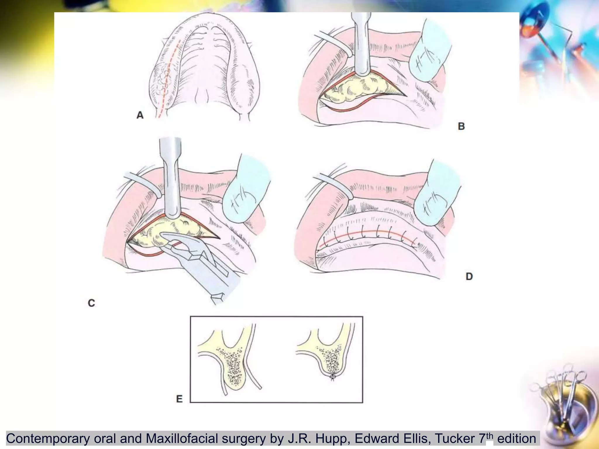 PREPROSTHETIC SURGERY 2.pptx