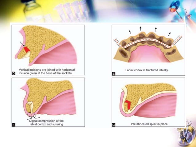 PREPROSTHETIC SURGERY 2.pptx | Dental Health | Diseases and Conditions