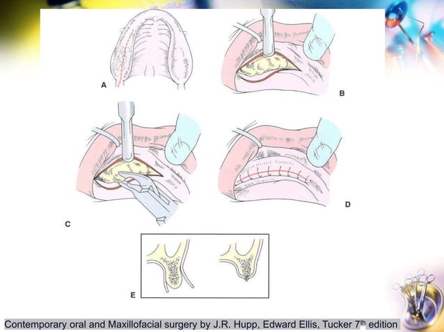 PREPROSTHETIC SURGERY 2.pptx | Dental Health | Diseases and Conditions
