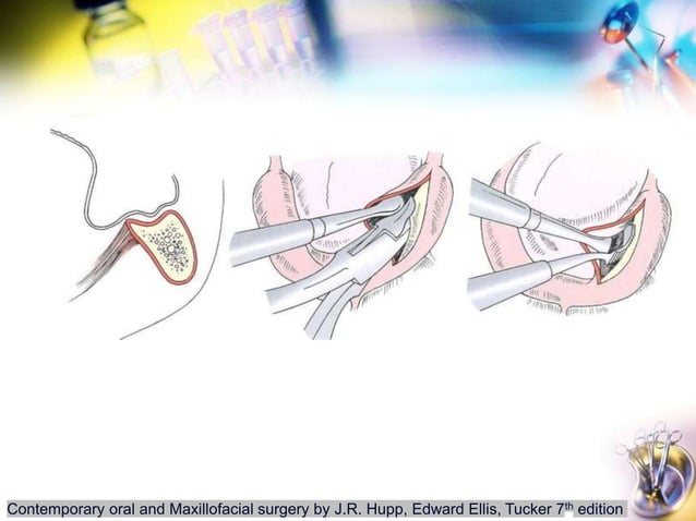 PREPROSTHETIC SURGERY 2.pptx | Dental Health | Diseases and Conditions