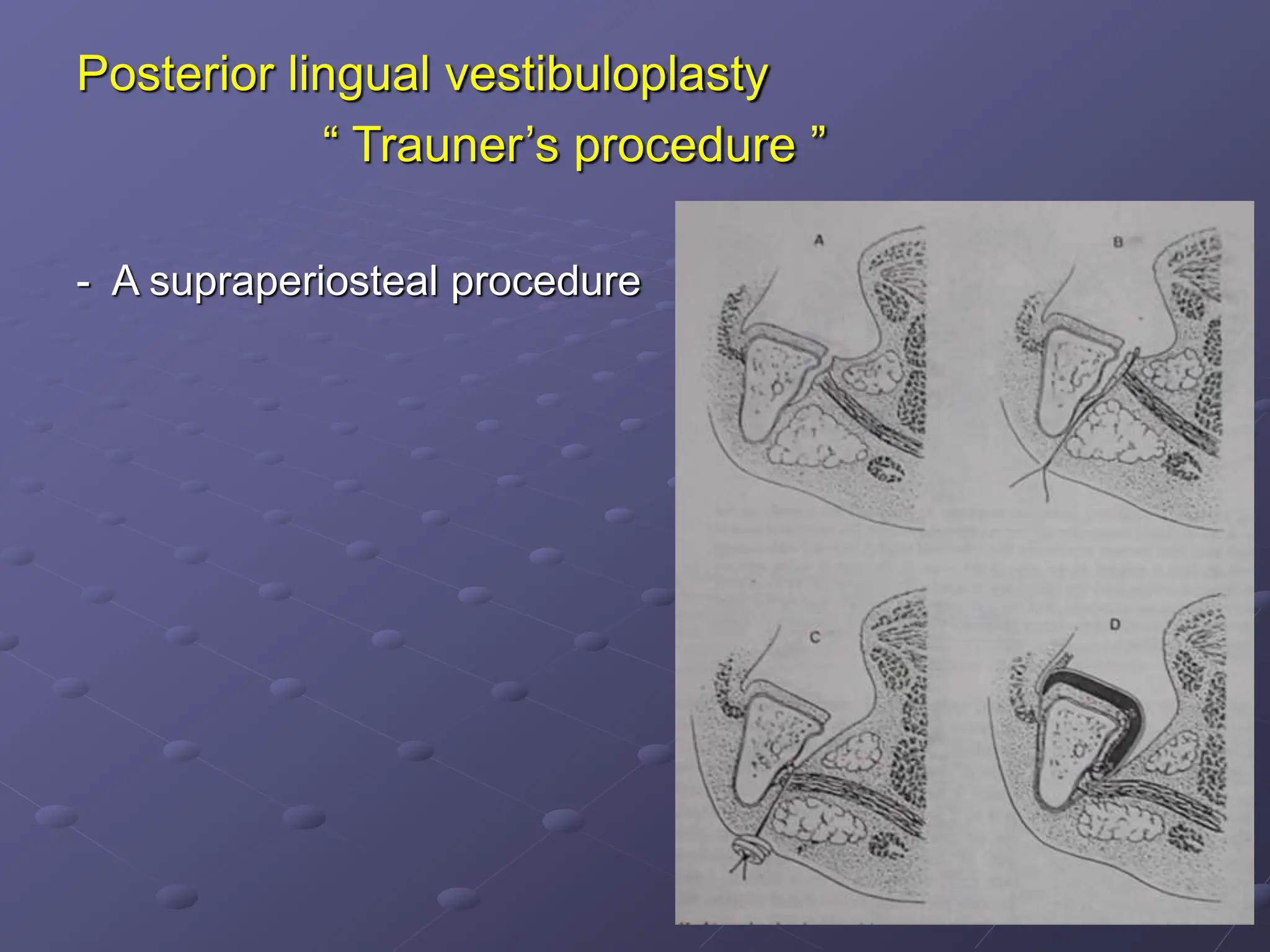 Preprosthetic surgery - ridge correction 2.ppt