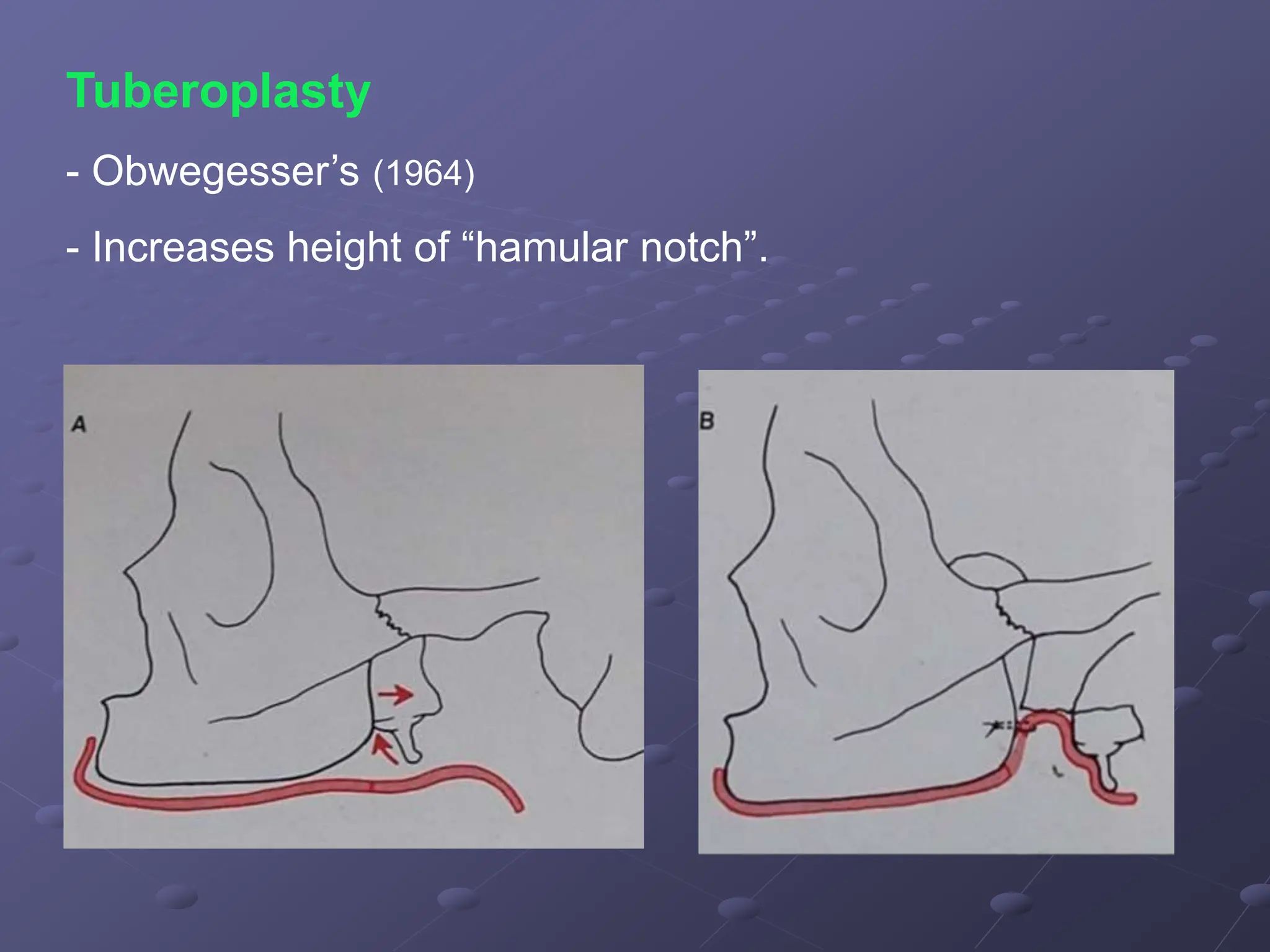 Preprosthetic surgery - ridge correction 2.ppt