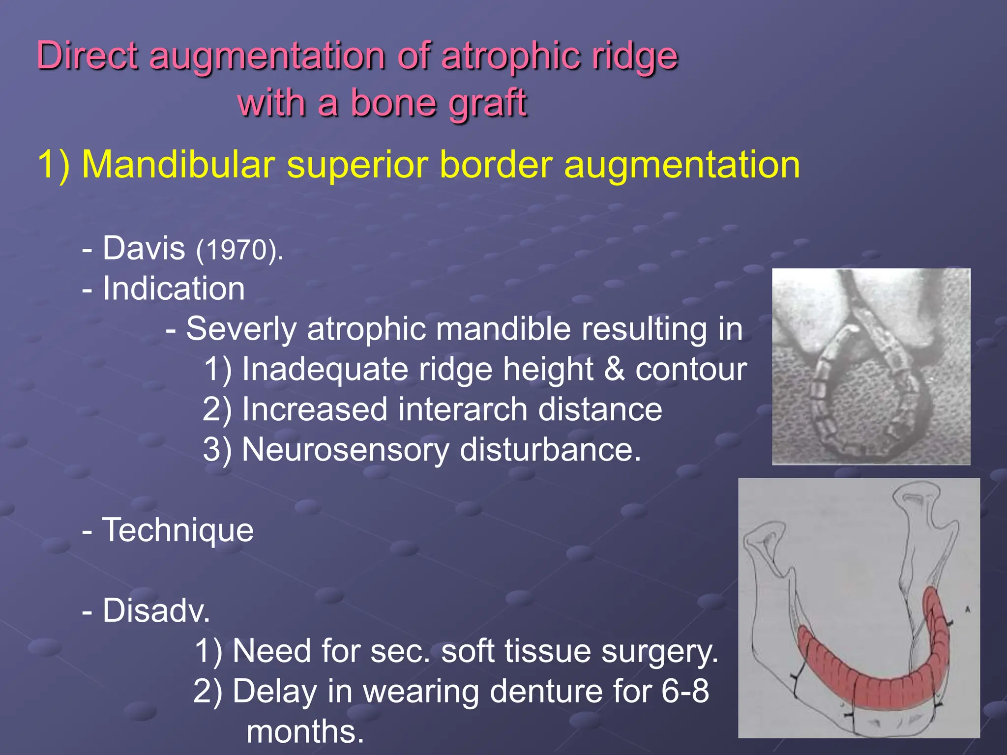 Preprosthetic surgery - ridge correction 2.ppt