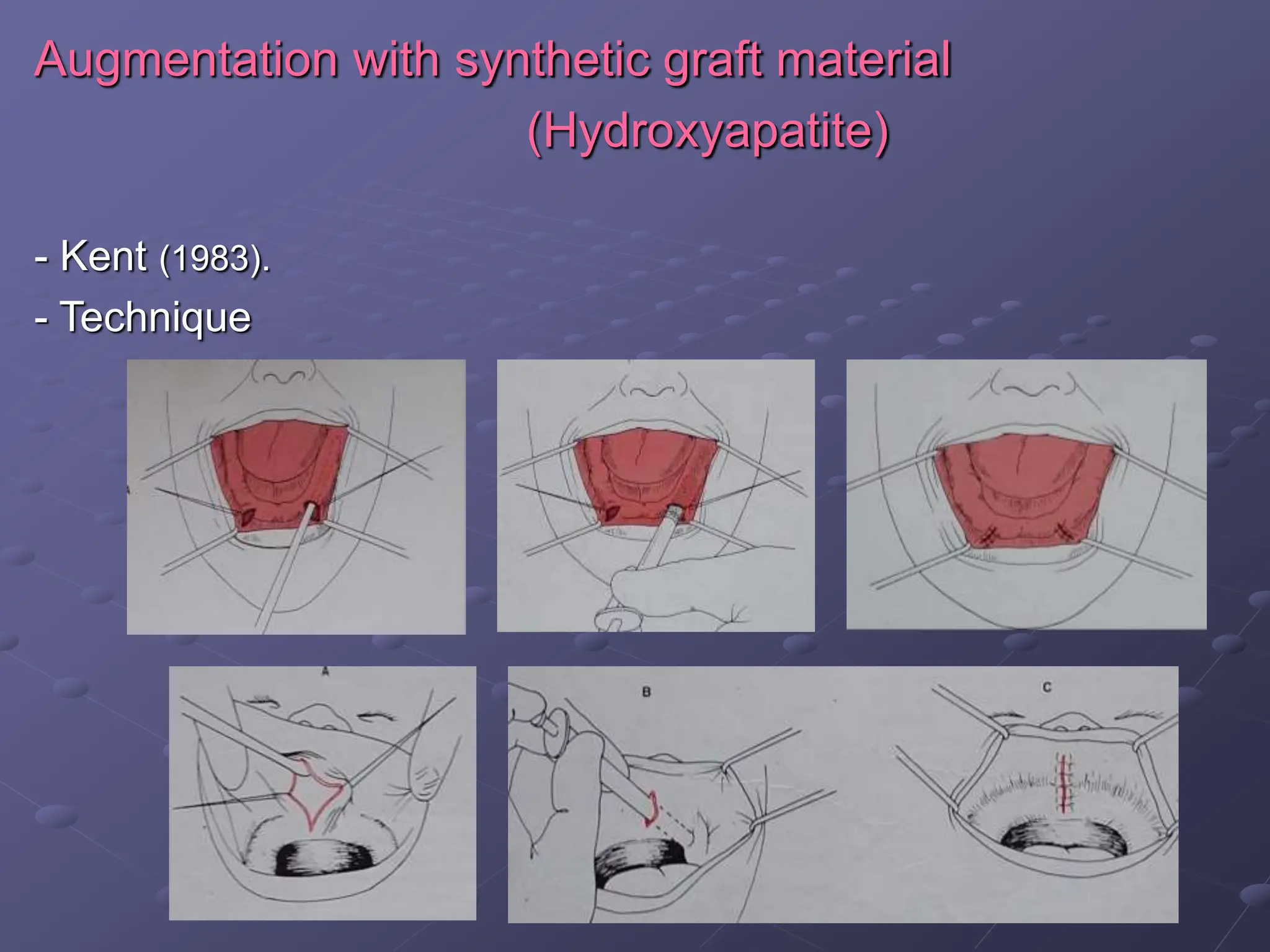 Preprosthetic surgery - ridge correction 2.ppt