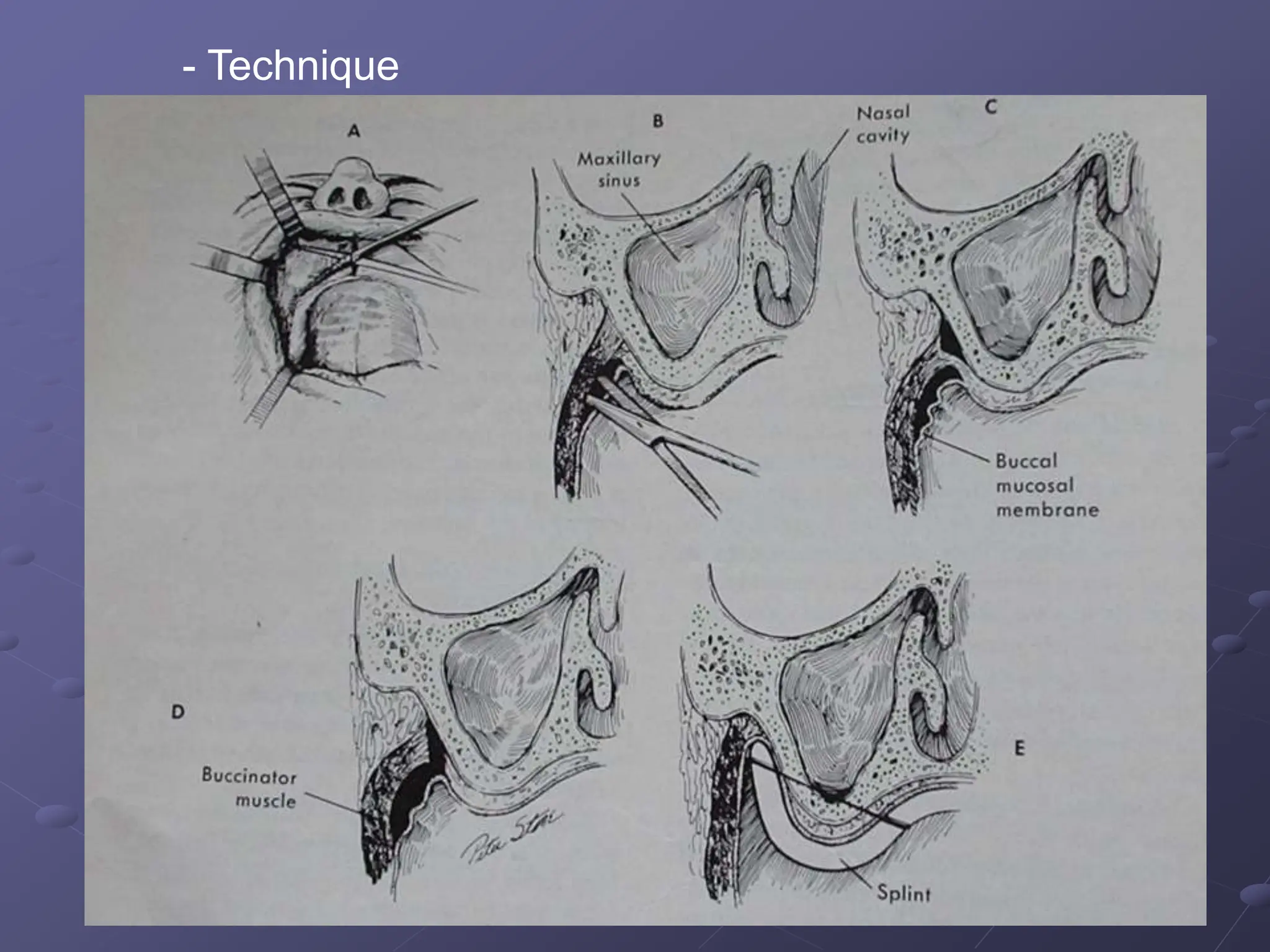 Preprosthetic surgery - ridge correction 2.ppt