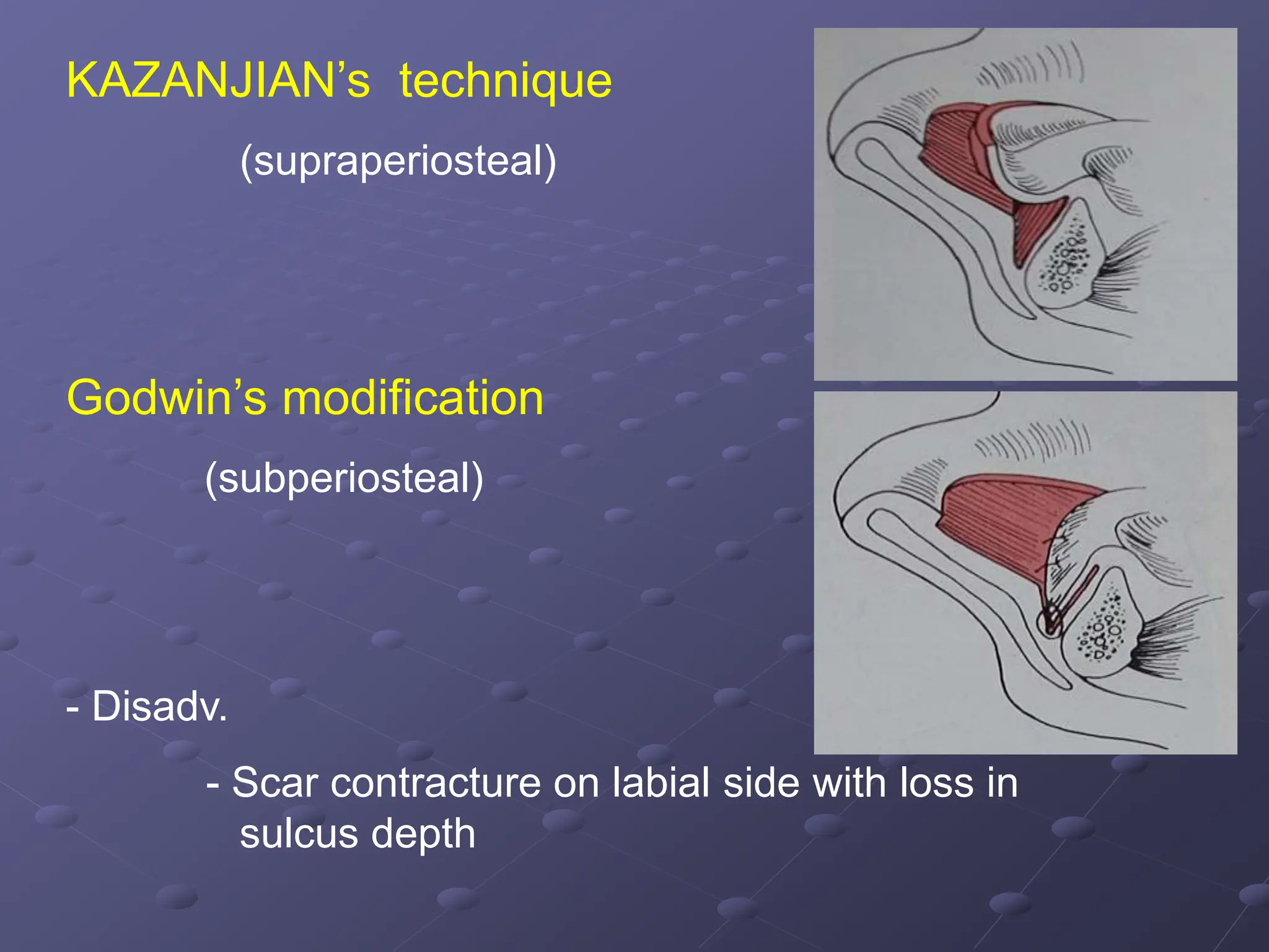 Preprosthetic surgery - ridge correction 2.ppt