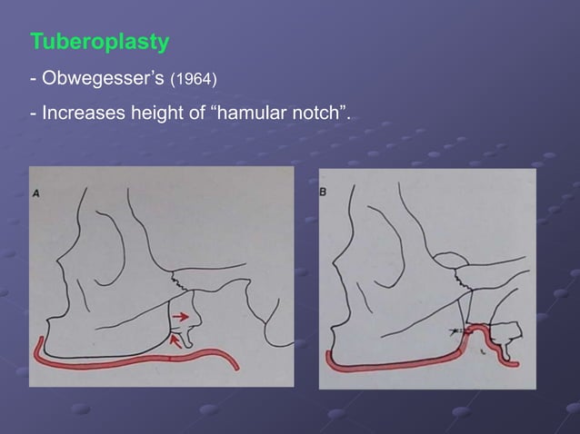 Preprosthetic surgery - ridge correction 2.ppt