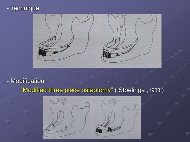 Preprosthetic surgery - ridge correction 2.ppt