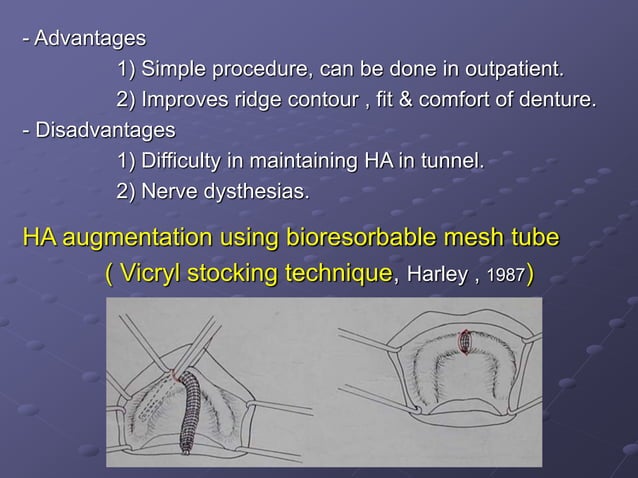 Preprosthetic surgery - ridge correction 2.ppt
