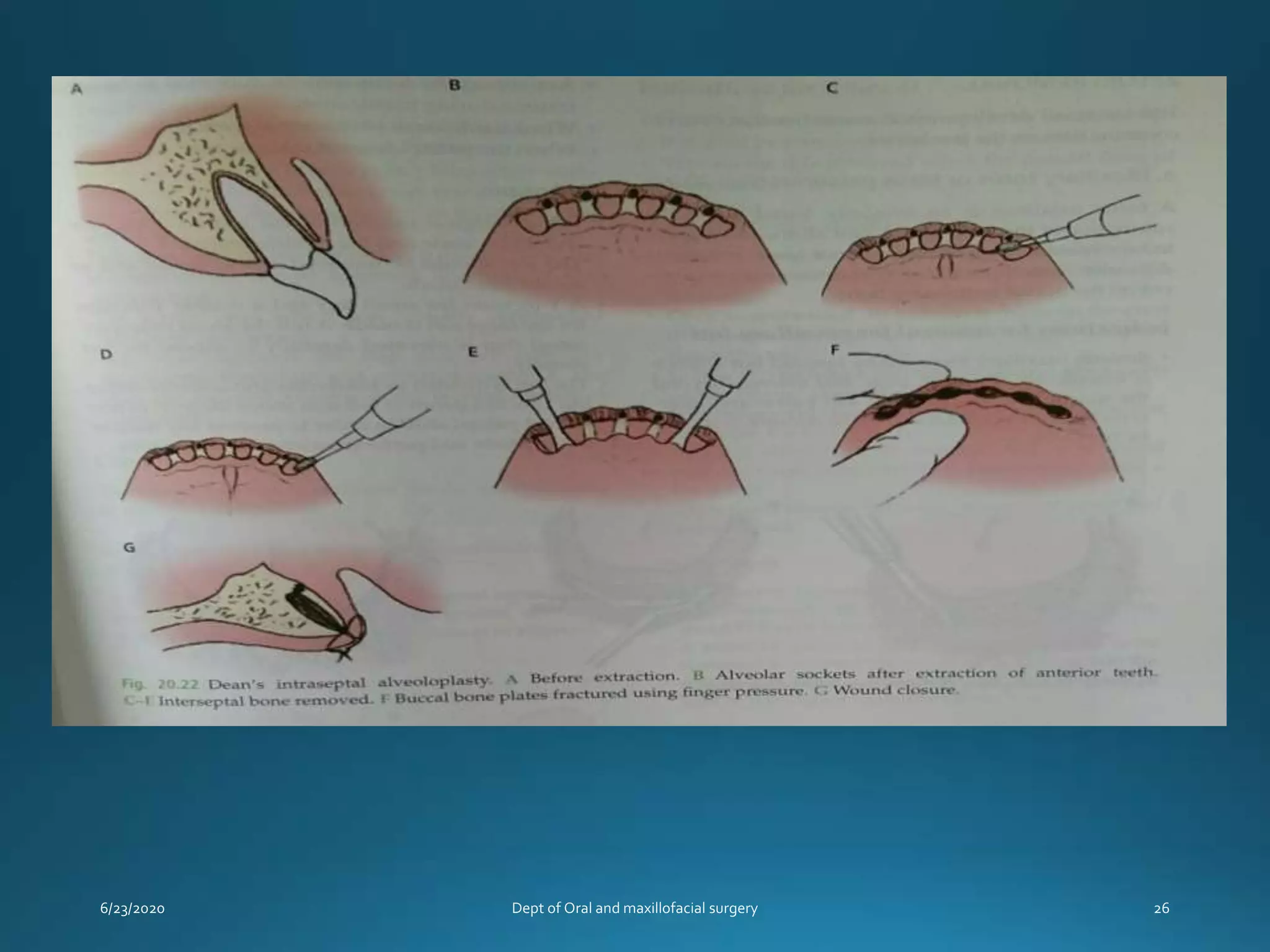 Preprosthetic surgery of maxilla | PPTX