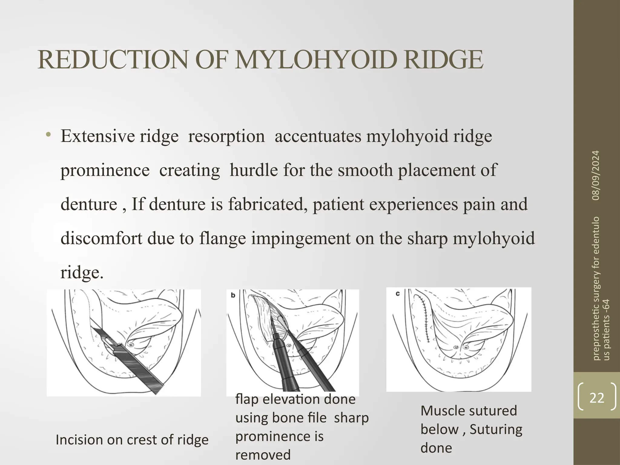 preprosthetic surgery seminar finalppt.pptx