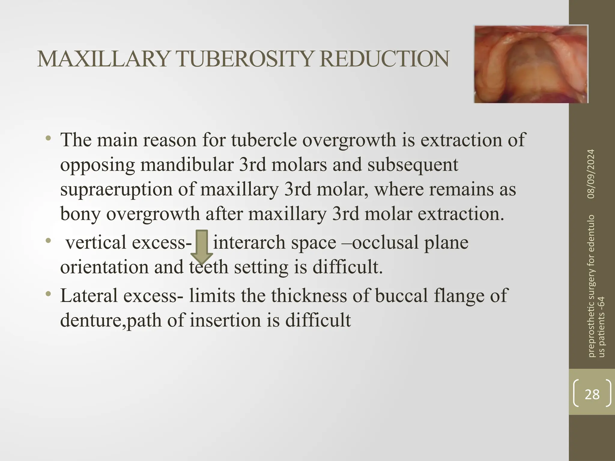 preprosthetic surgery seminar finalppt.pptx