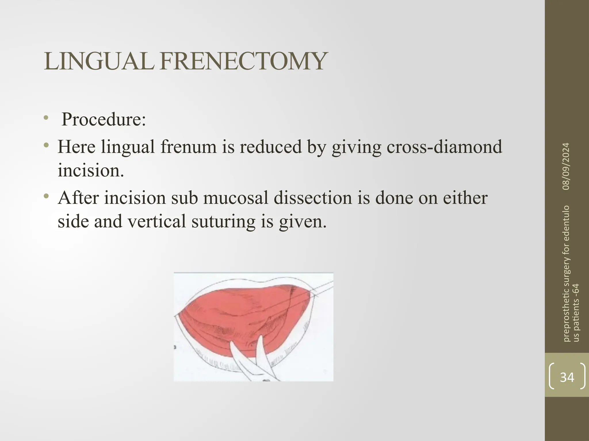 preprosthetic surgery seminar finalppt.pptx