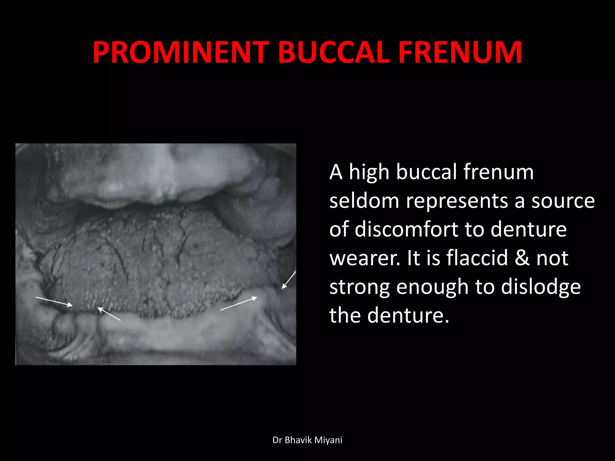 Pre-Prosthetic Surgery | PPT