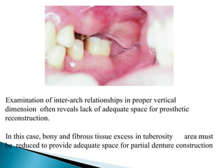 PREPROSTHTIC SURGERY In oral surgery and endo | PPTX