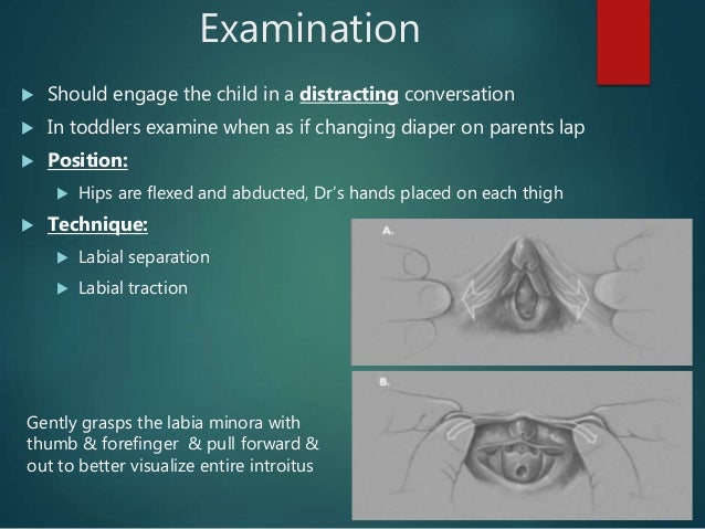 Labial Traction PDF) Genital Anatomy In Non Abused Preschool Girls