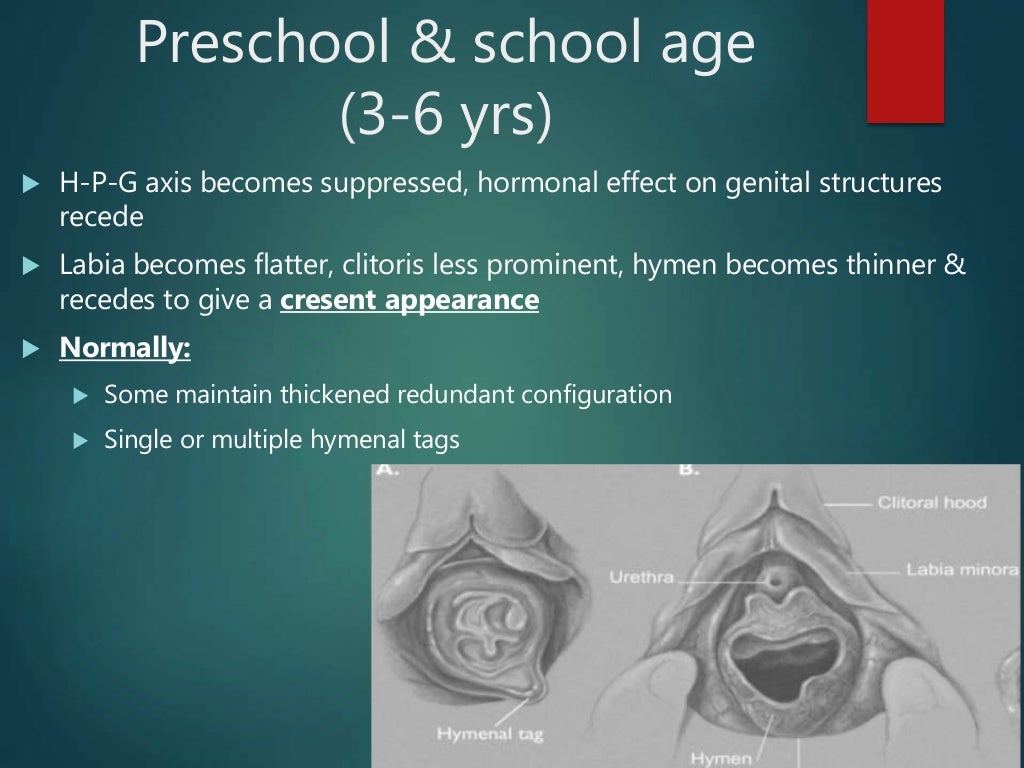 Prepubertal bleeding