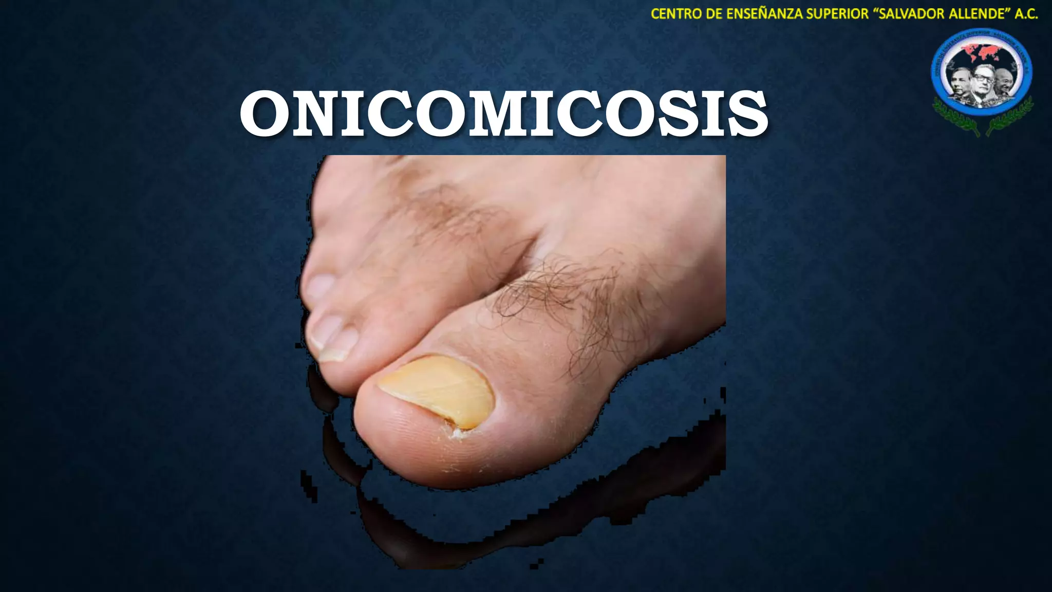 Patologías Ungueales: Onicocriptosis, Onicomicosis y Onicogrifosis. | PPTX