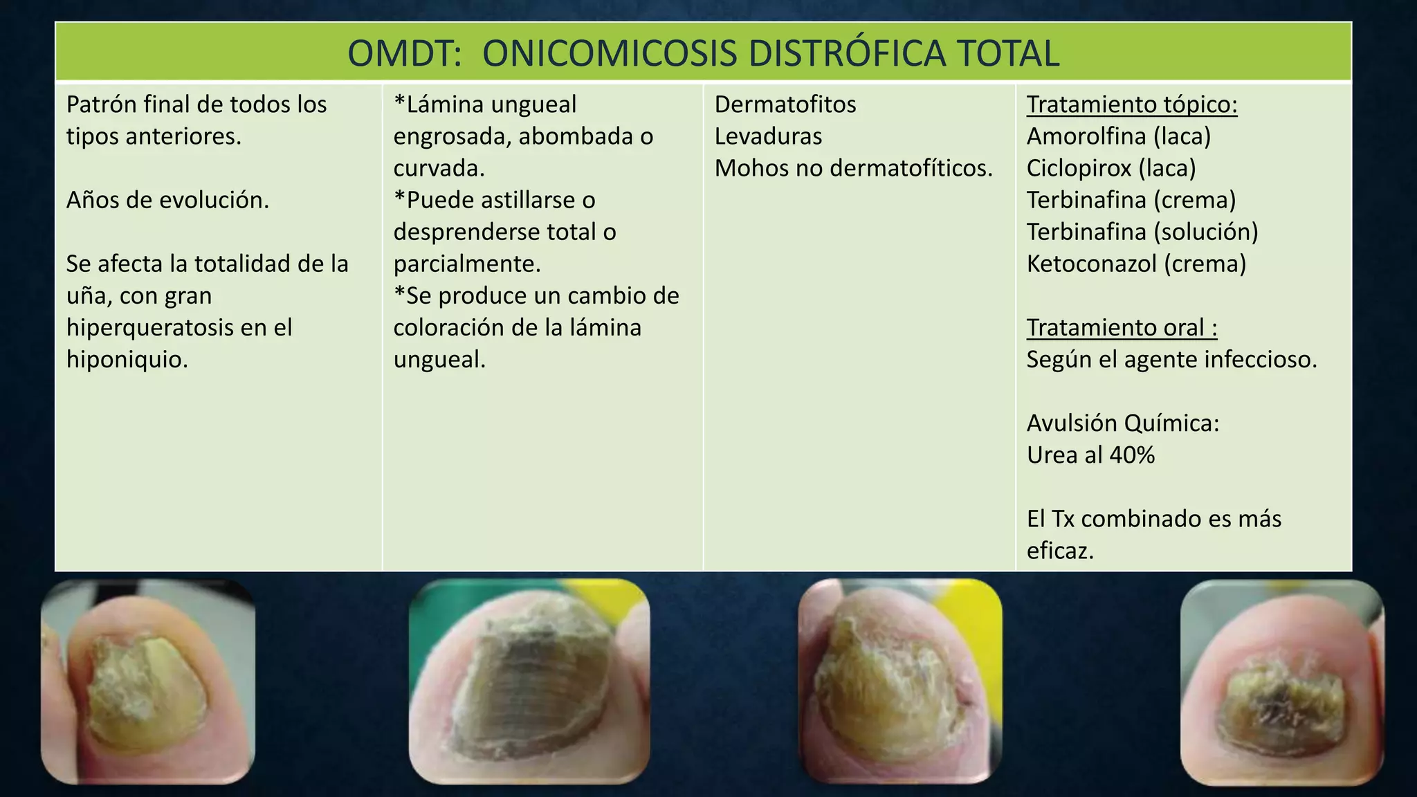 Patologías Ungueales: Onicocriptosis, Onicomicosis y Onicogrifosis. | PPTX