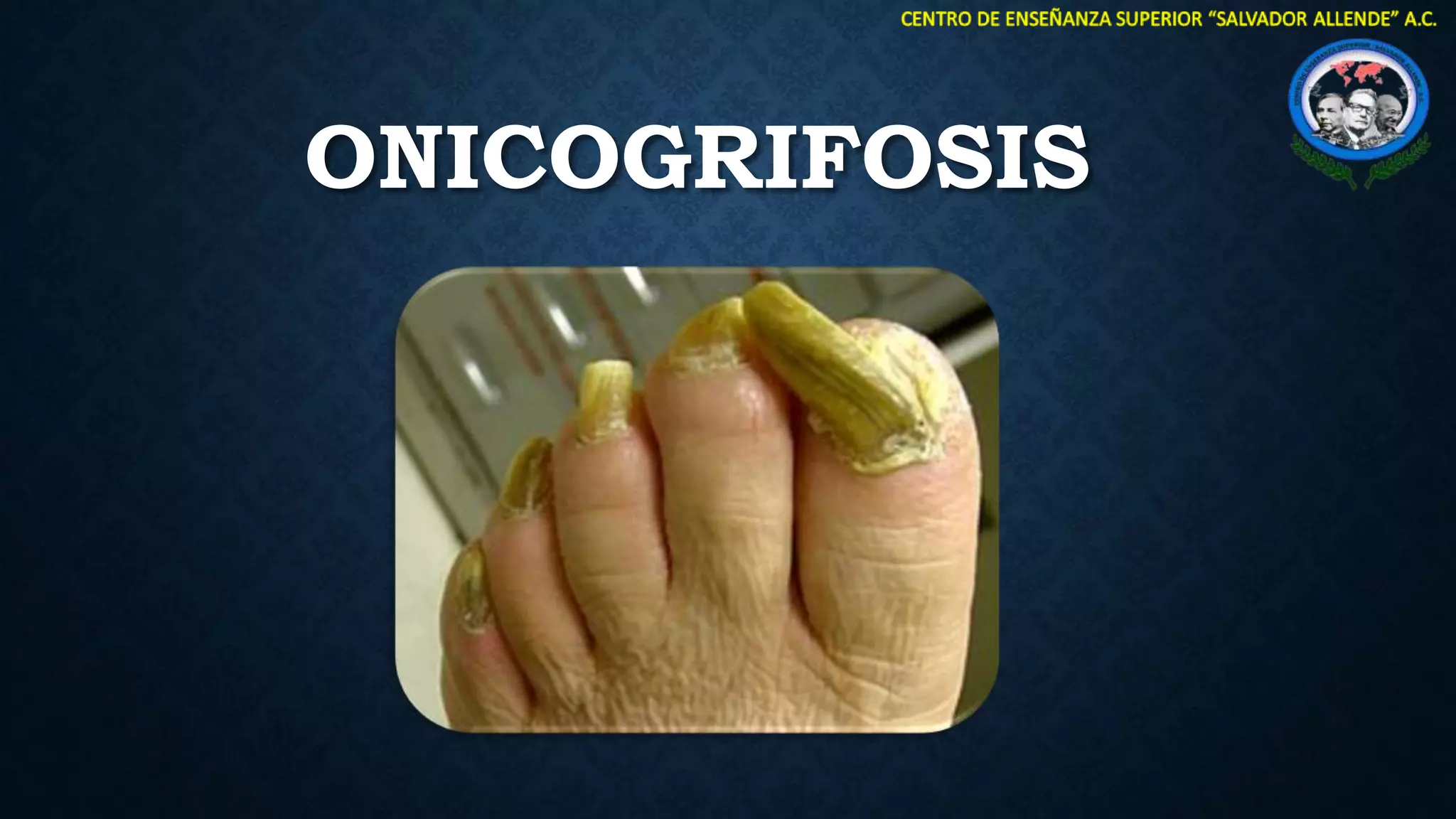 Patologías Ungueales: Onicocriptosis, Onicomicosis y Onicogrifosis. | PPTX