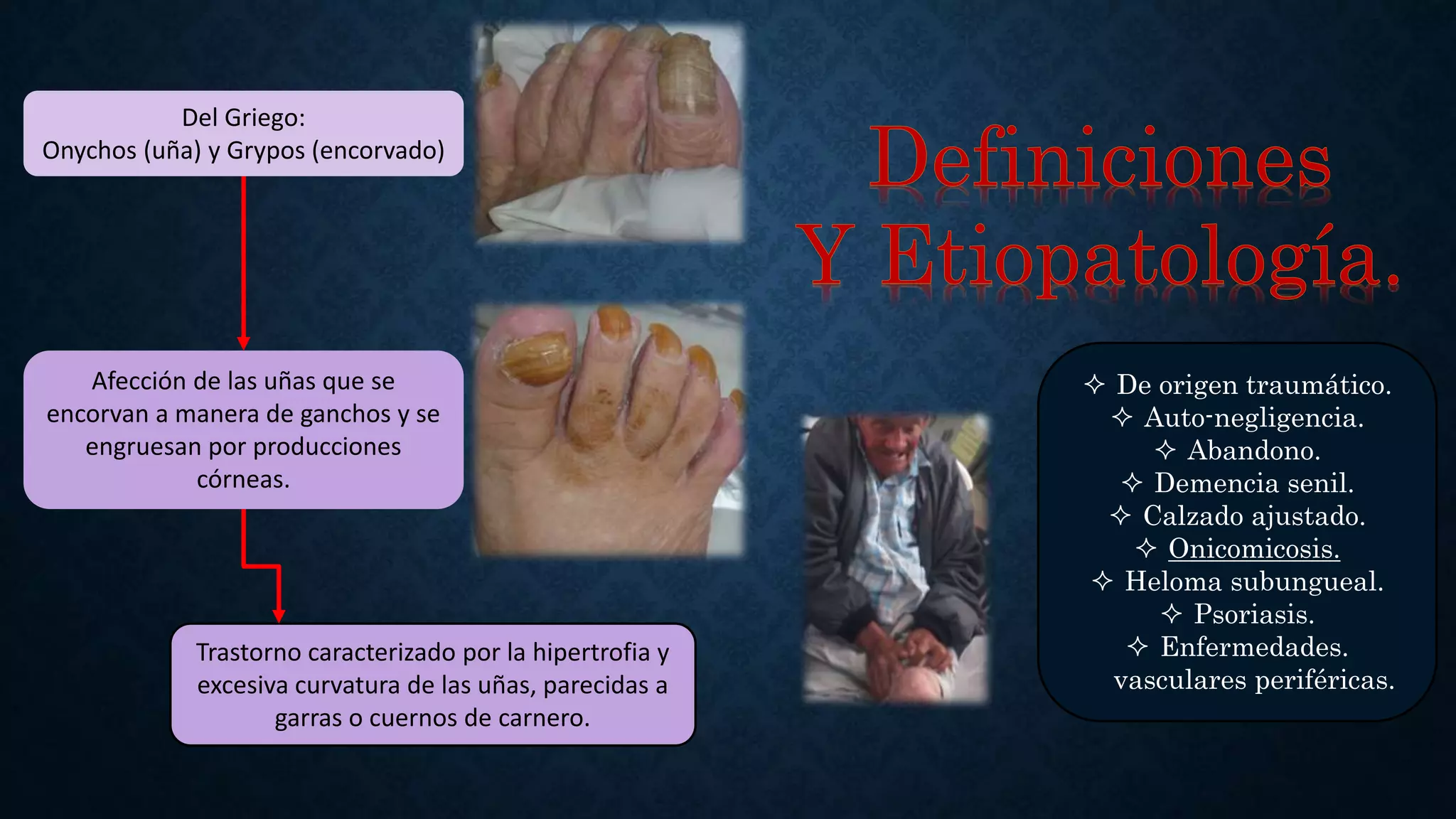 Patologías Ungueales: Onicocriptosis, Onicomicosis y Onicogrifosis. | PPTX