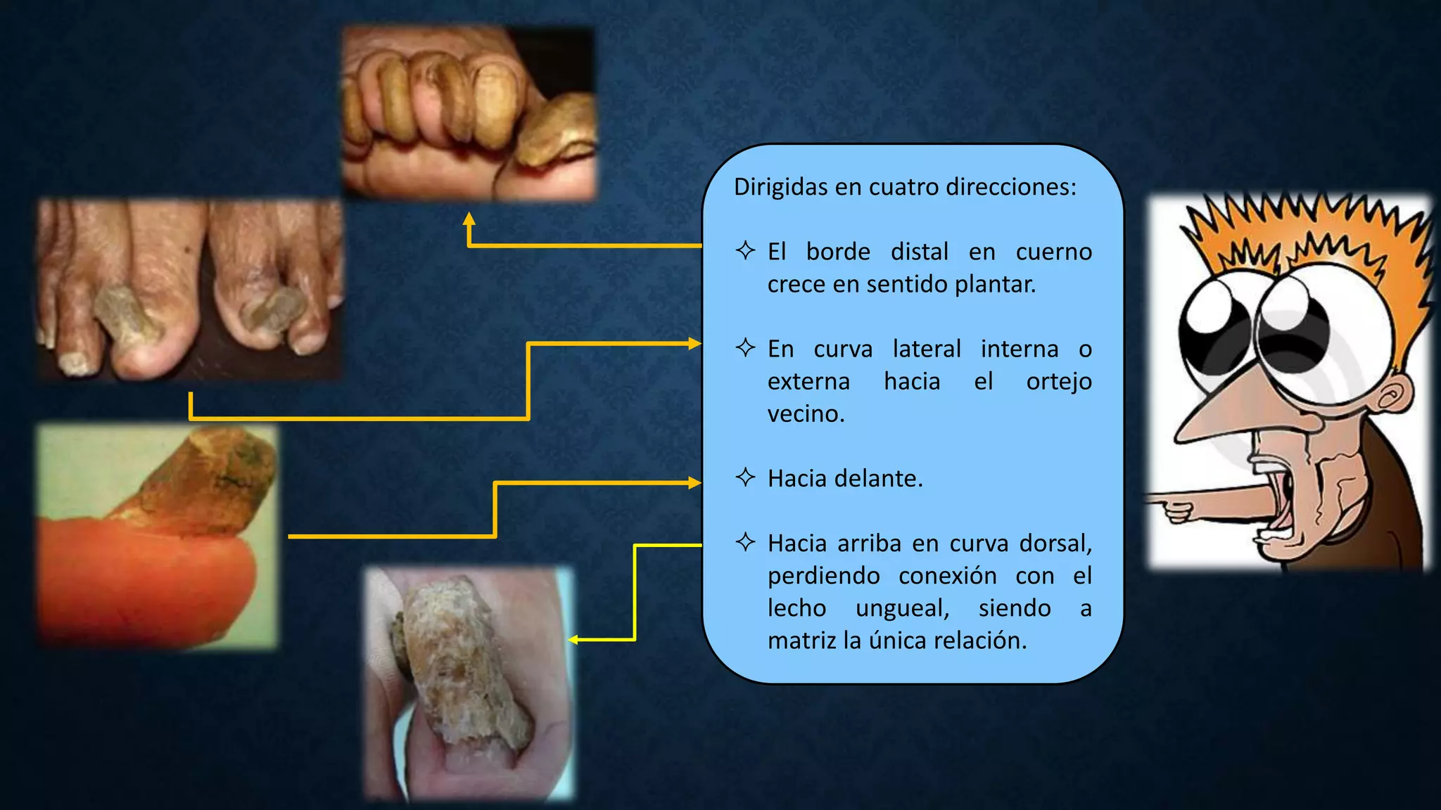 Patologías Ungueales: Onicocriptosis, Onicomicosis y Onicogrifosis. | PPTX