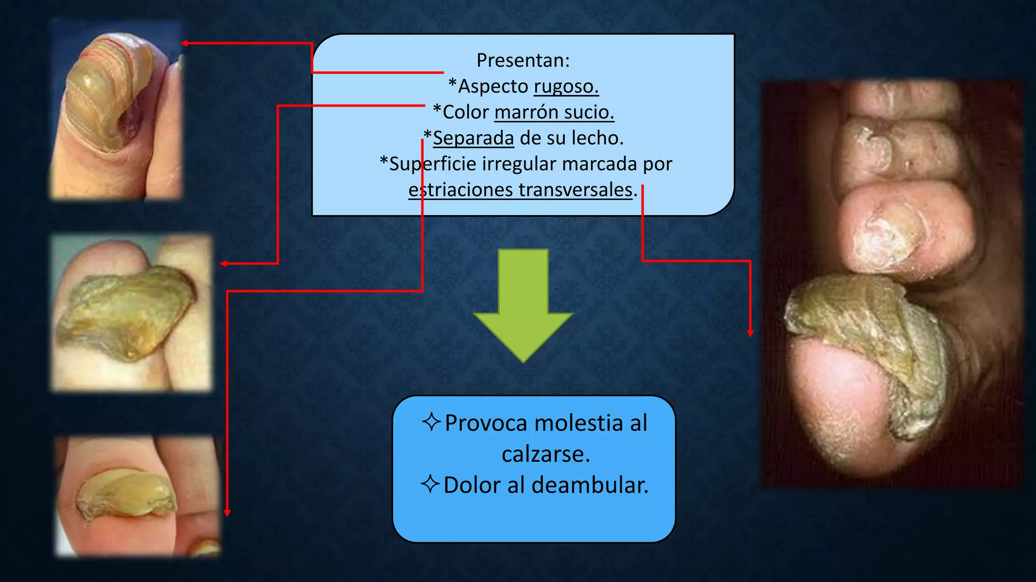 Patologías Ungueales: Onicocriptosis, Onicomicosis y Onicogrifosis. | PPTX