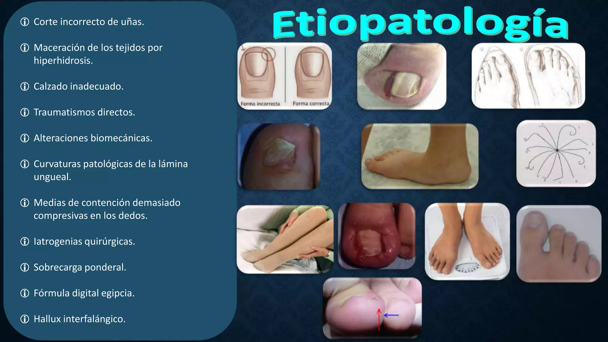 Patologías Ungueales: Onicocriptosis, Onicomicosis y Onicogrifosis. | PPTX