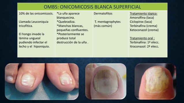 Patologías Ungueales: Onicocriptosis, Onicomicosis y Onicogrifosis. | PPTX