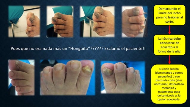 Patologías Ungueales: Onicocriptosis, Onicomicosis y Onicogrifosis. | PPTX