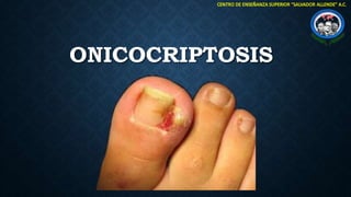 Patologías Ungueales: Onicocriptosis, Onicomicosis y Onicogrifosis. | PPT