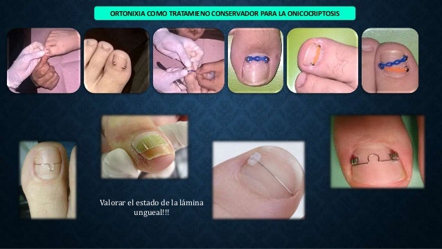 Patologías Ungueales: Onicocriptosis, Onicomicosis y Onicogrifosis.