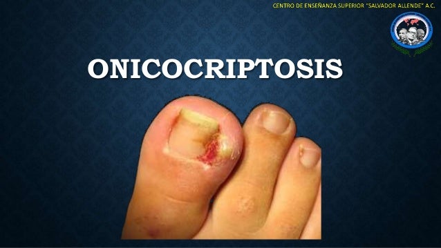 Patologías Ungueales: Onicocriptosis, Onicomicosis y Onicogrifosis.
