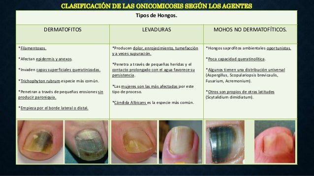 Patologías Ungueales: Onicocriptosis, Onicomicosis y Onicogrifosis.